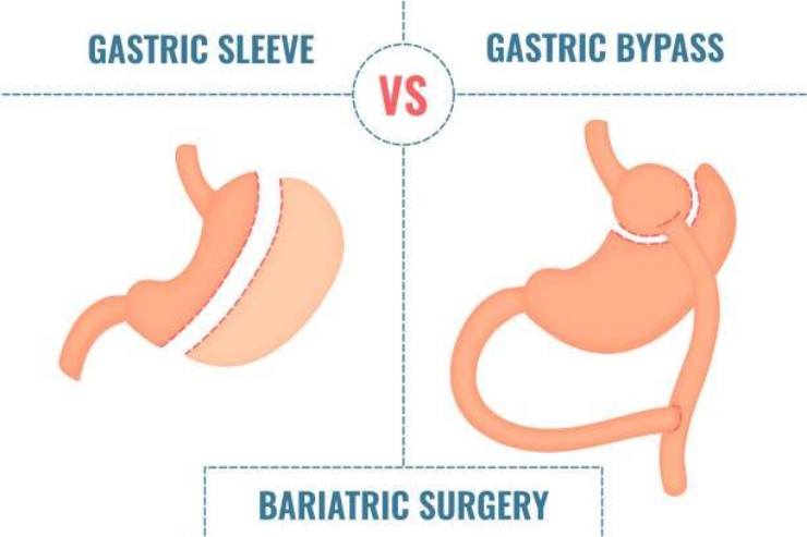 Quelle est la différence entre la sleeve gastrique et le bypass ...