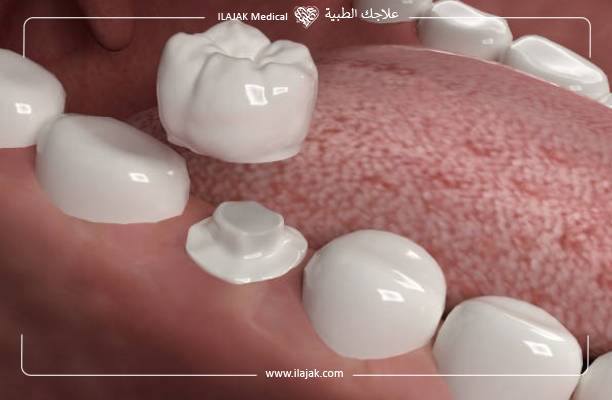 What are 4 common alternatives to dental implants ? | ILAJAK Medical