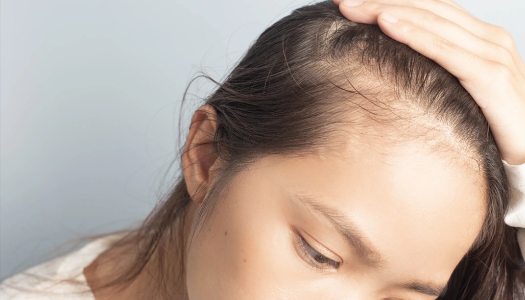 إجراءات وتكاليف زراعة شعر مقدمة الرأس للنساء 2025 | علاجك الطبية