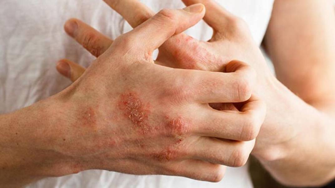 Quelles sont les causes de l'eczéma ? | Ilajak médical