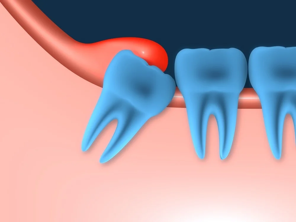 What are wisdom teeth and reasons to get them removed? | ILAJAK Medical
