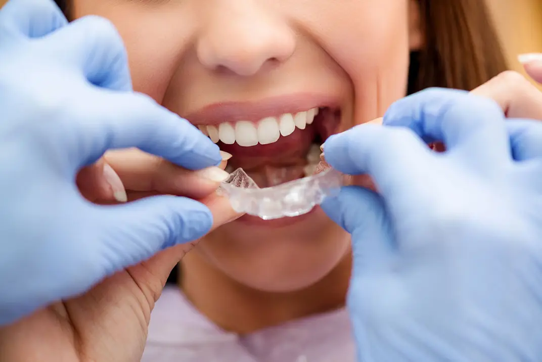 Removable Braces: Pros, Cons, and Cost | ILAJAK Medical