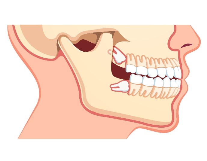ILAJAK Medical | Benefits of keeping wisdom teeth and how to know if ...