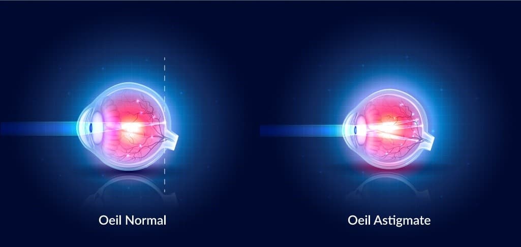 L'astigmatisme : causes et traitements | Ilajak médical