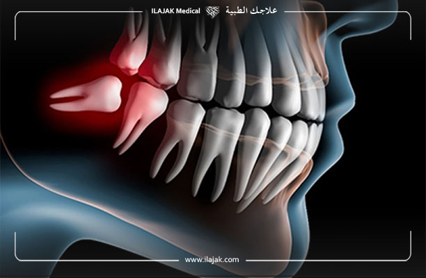 Ilajak médical | Guide : opération d’extraction de la dent de sagesse