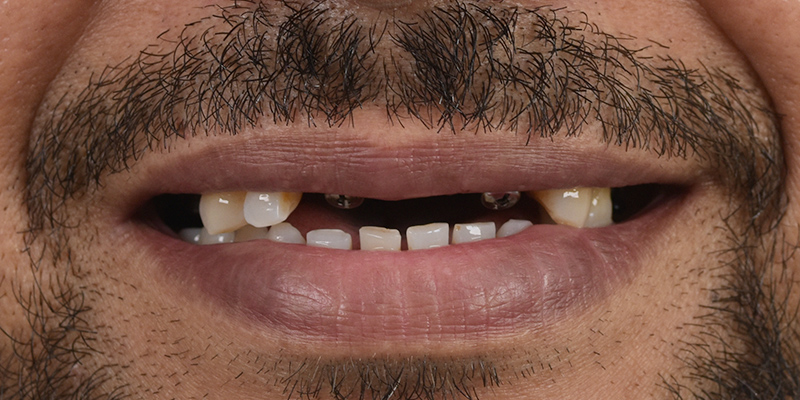 Dental Treatment in Turkey | ILAJAK Medical